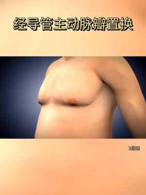 经导管主动脉瓣置换术:在原来瓣膜的位置植入新的瓣膜,用于严重.