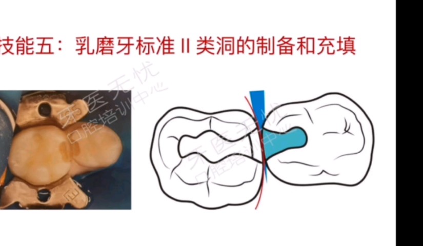 杨杰 技能五 乳磨牙标准二类洞的制备和充填