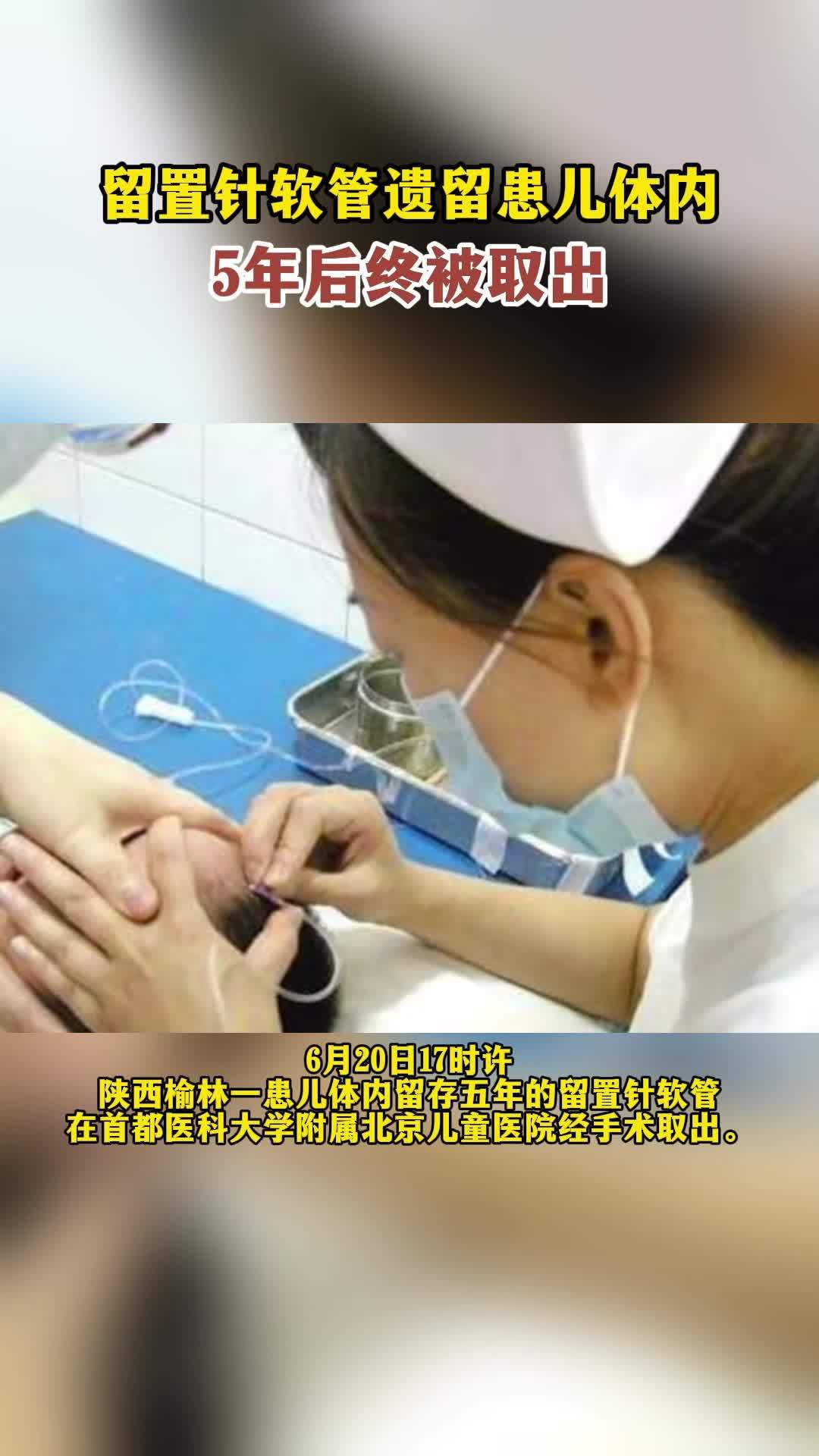 留置针软管遗留患儿体内,5年后终被取出