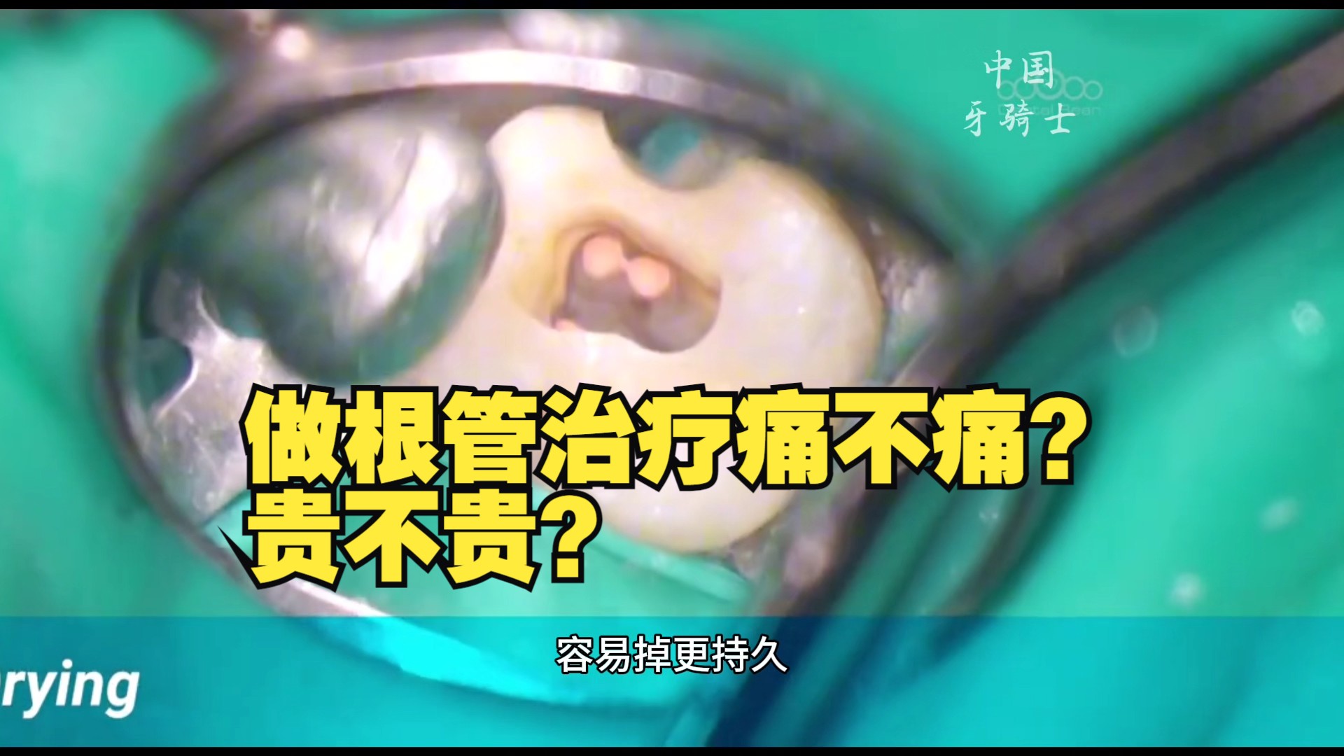 临床根管治疗过程,做根管治疗痛不痛?贵不贵?