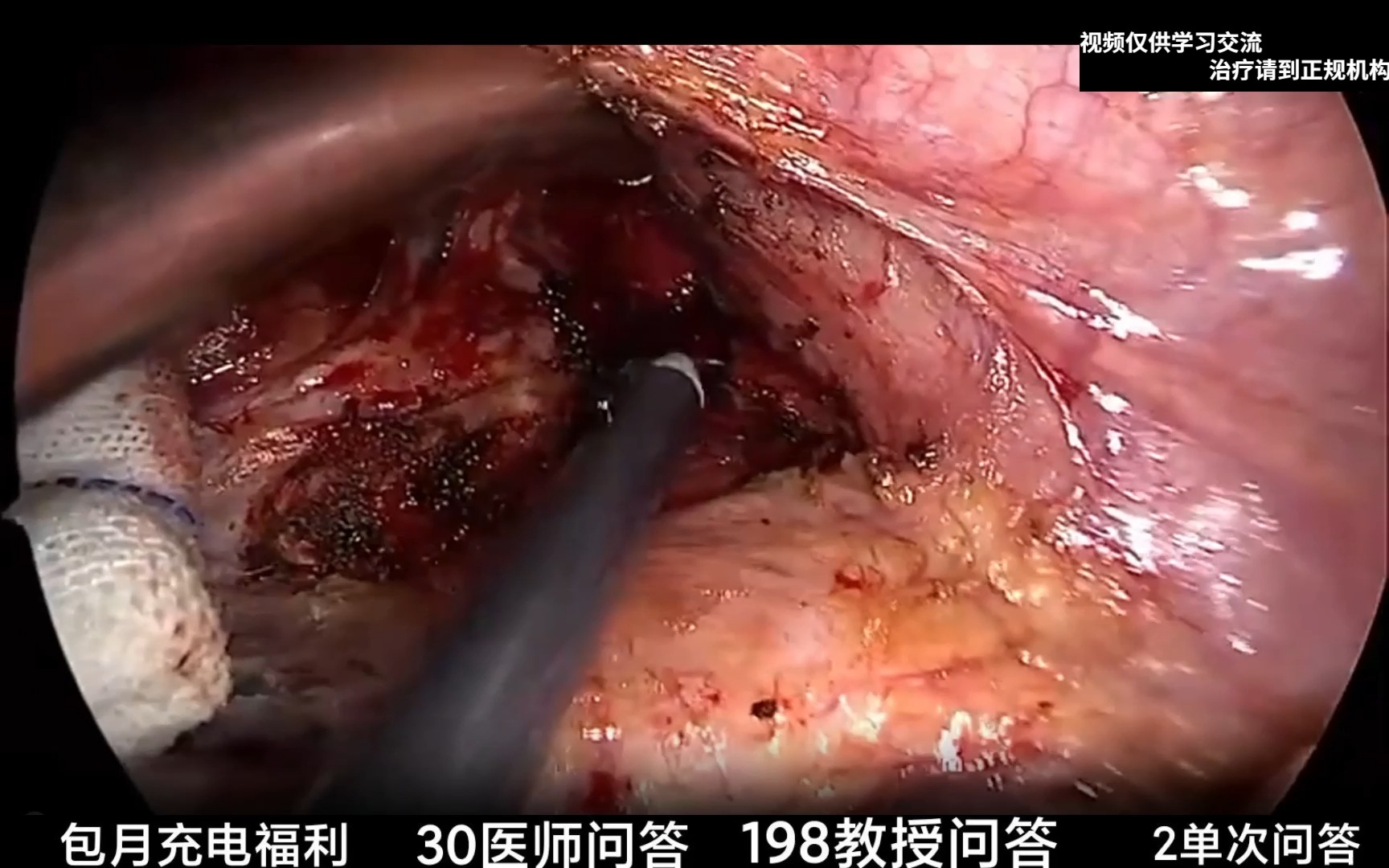 胸腔镜下肺楔形切除➕淋巴结清扫