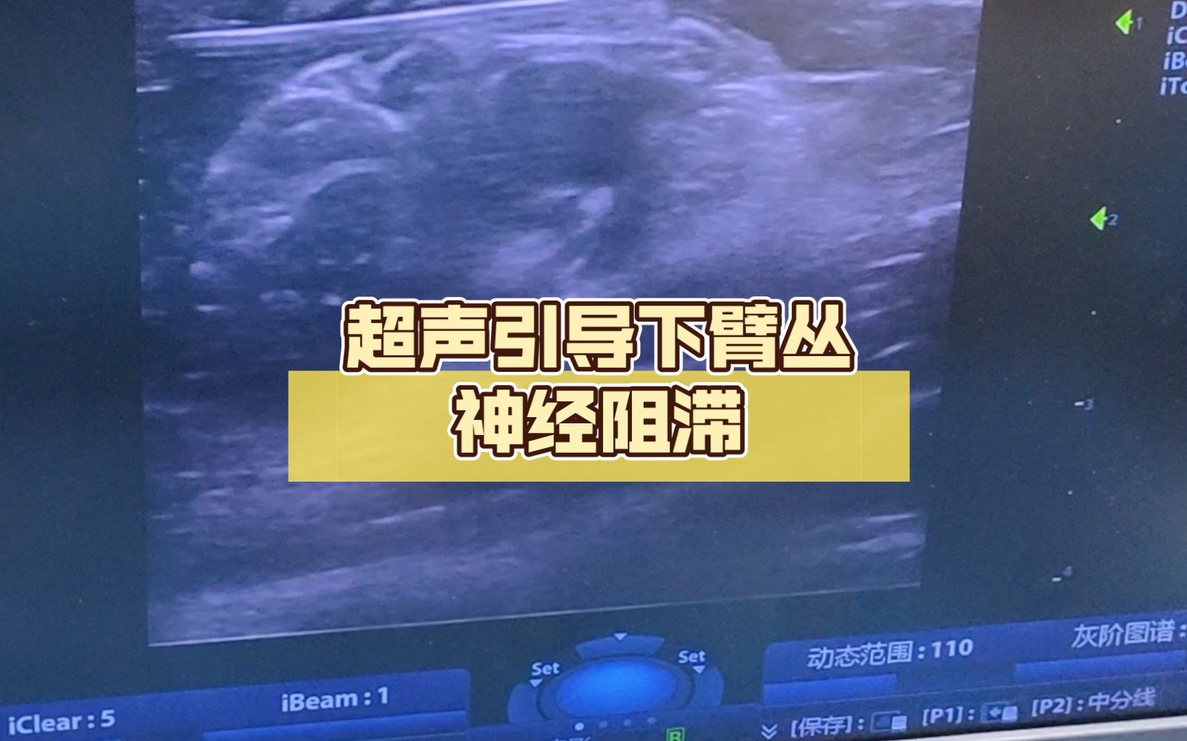 超声引导下臂丛神经阻滞(腋路)