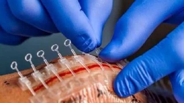 现实版舒痕膏?美国Zip“拉链”轻轻一拉真的能让伤口不留疤...