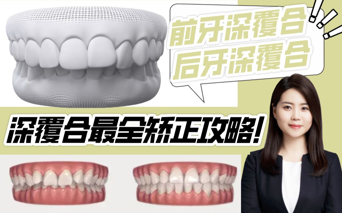 什么是深覆合?要如何改善?
