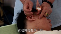 火针治疗耳聋耳鸣,火针疗法视频,中医针灸火针教学视频培训班