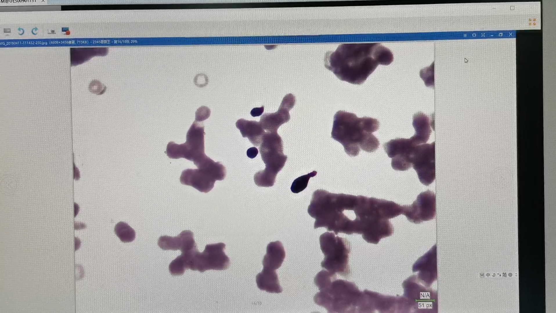 【血细胞】缺铁性贫血 IDA