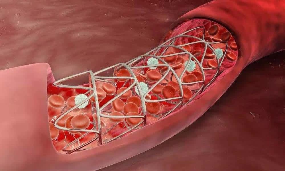 你知道心脏支架的寿命有多少年吗?今天告诉你答案