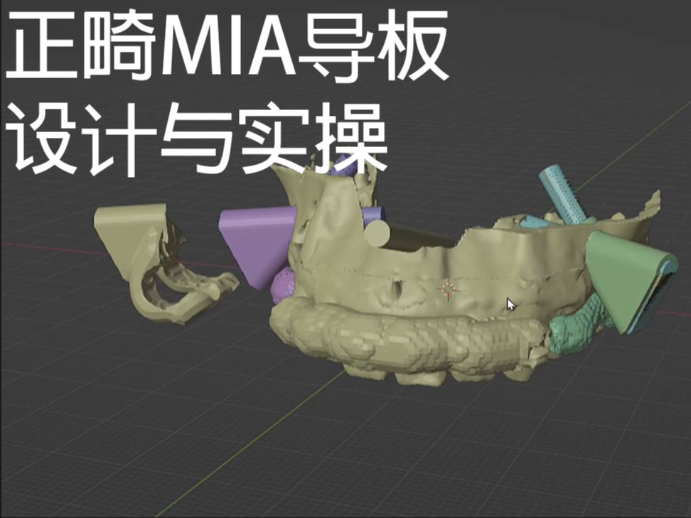 正畸MIA导板设计与实操