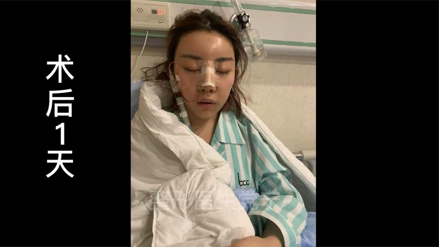 大腿吸脂后做隆鼻整形记录,超真实手术前后全过程,妹子换了张脸
