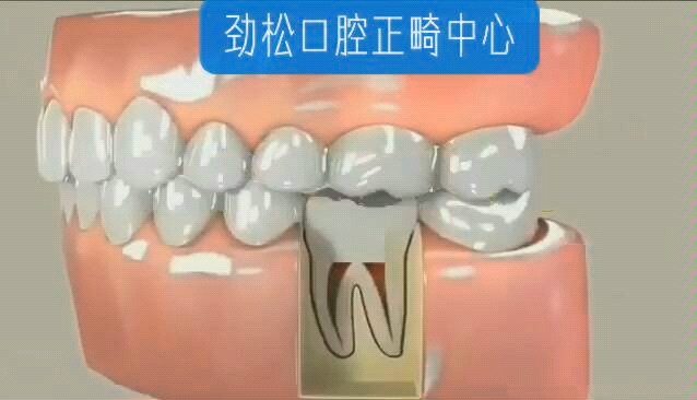 牙齿做过根管治疗后不做牙冠会怎样?