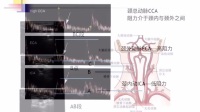 颈部血管彩超操作讲解.MOV