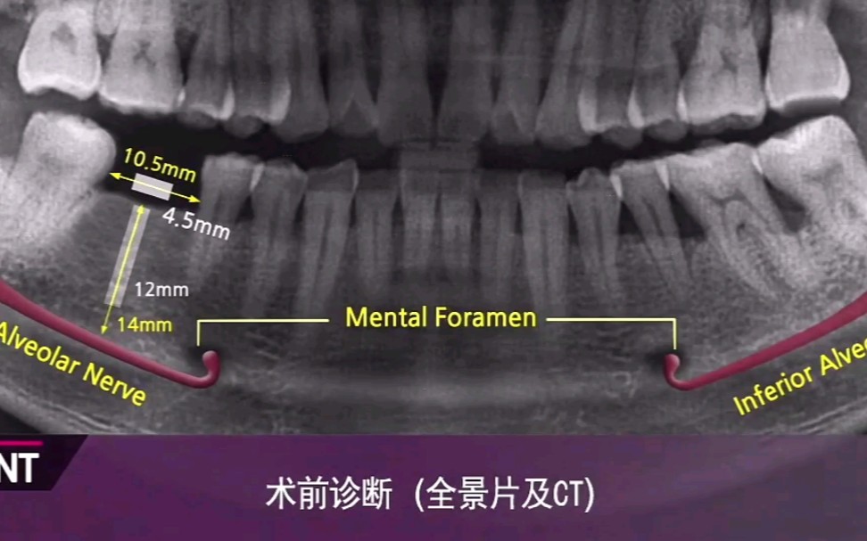 5分钟了解种植牙全过程,牙齿缺失了种一颗和真牙一样