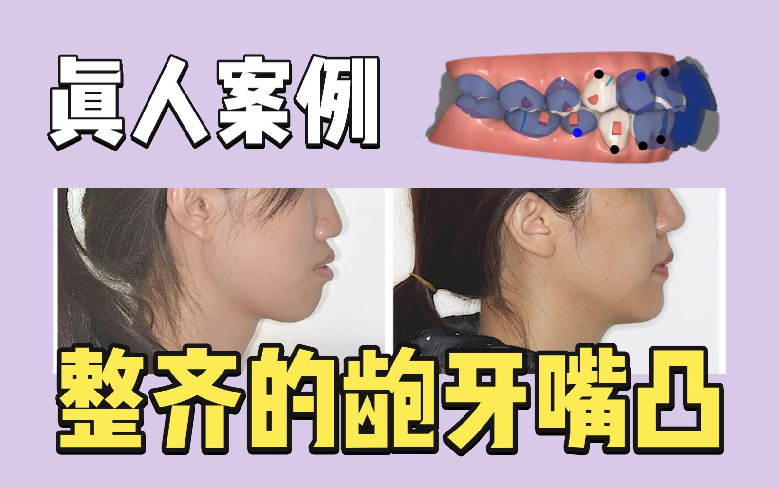 真人动画案例 | 整齐的龅牙、嘴凸拔牙矫治,改善侧貌