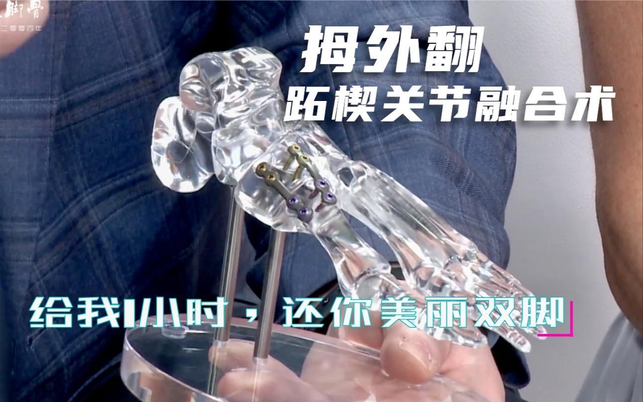 跖楔关节融合术介绍,有效矫正拇外翻手术方案之一