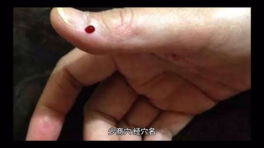 嗓子痛~消炎大穴~少商穴