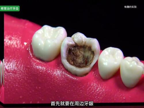 全程无尿点给你的牙齿做根管治疗,别咬着牙看哦