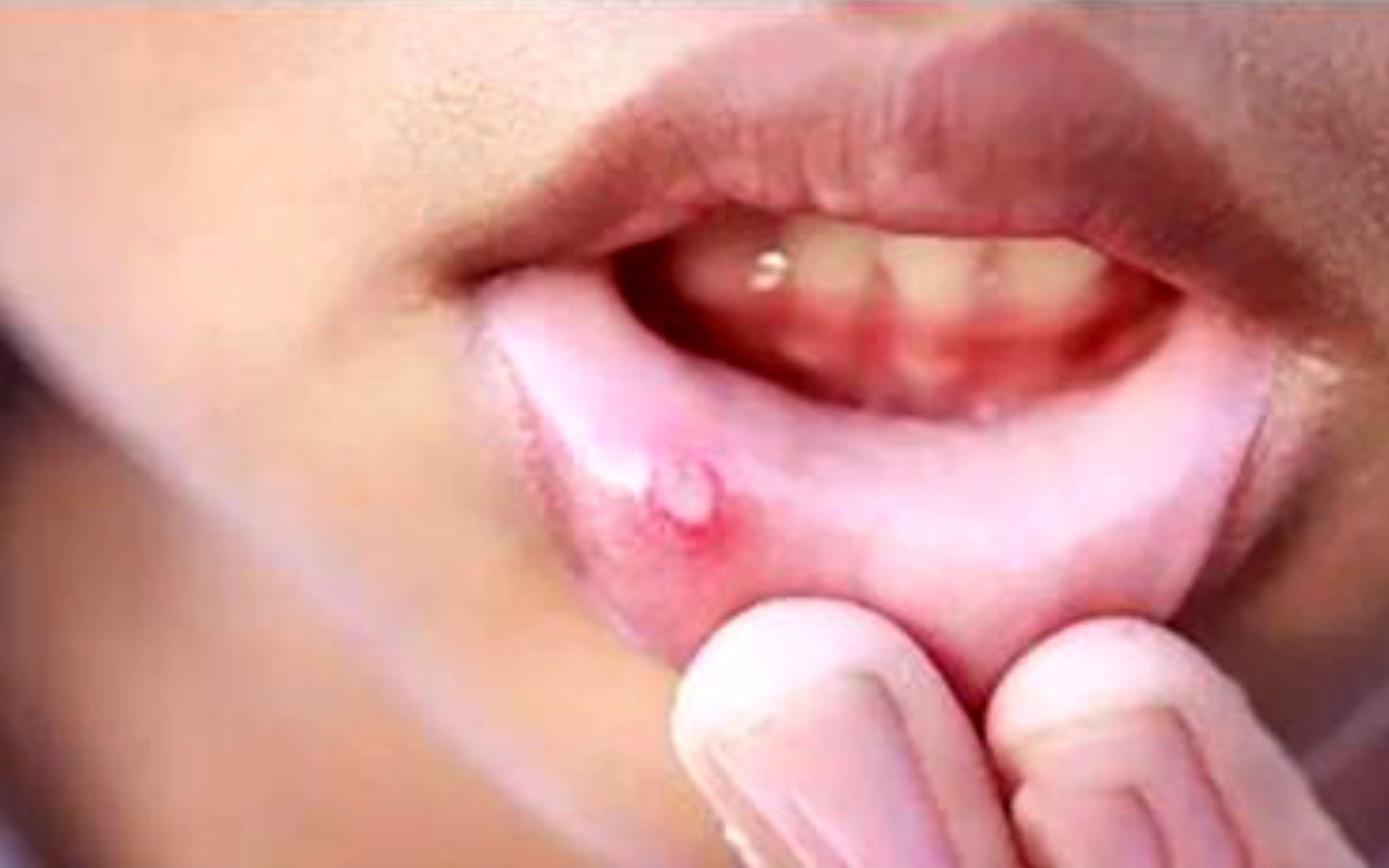 口腔溃疡是什么原因?把溃疡组织放大1000倍,看完要注意了