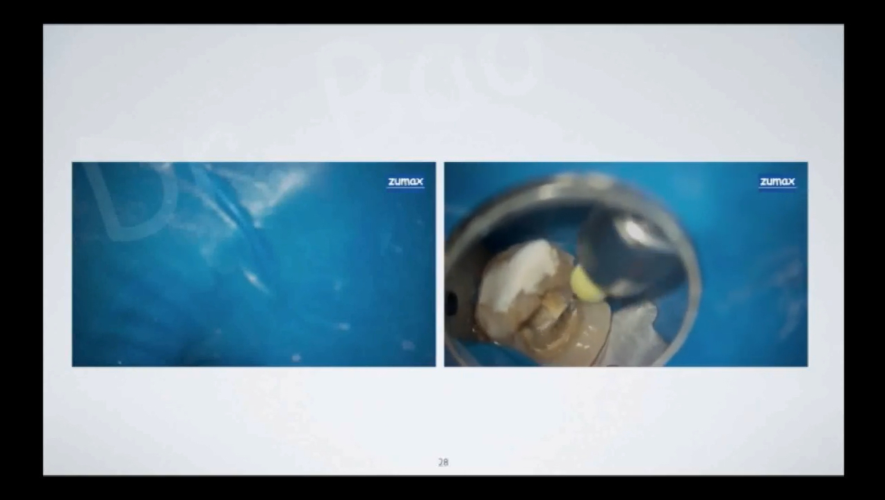 重度弯曲根管的预备和充填——包老师