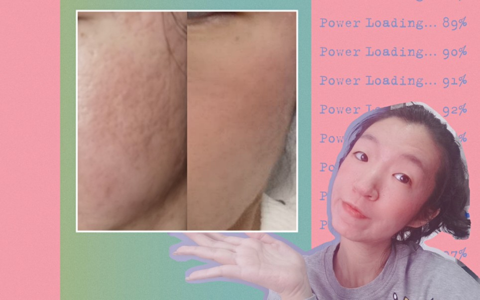 【医美分享—痘坑治疗】皮下分离一个月+plasma十天后恢复效果