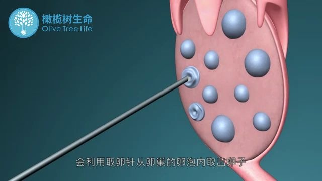 橄榄树生命三代试管婴儿——3D动画演示体外受精过程
