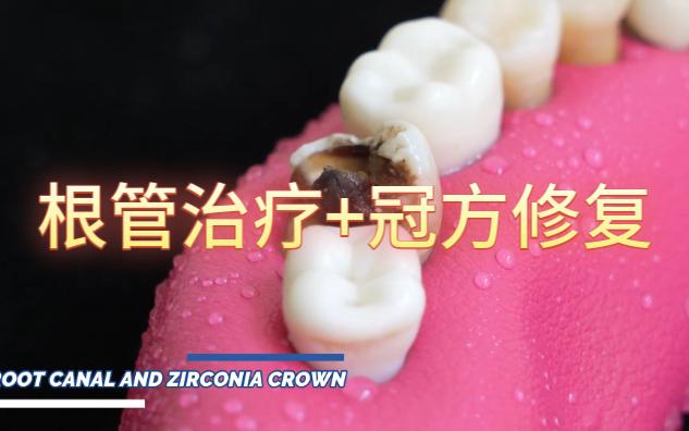 根管治疗+冠方修复