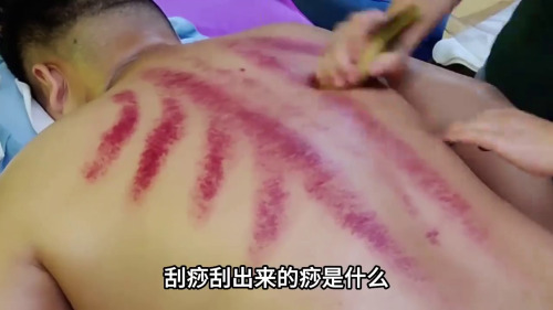 刮痧刮出来的痧是什么?真的是体内毒素吗?出痧越多越好吗?