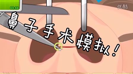 【中国BOY】如何给鼻子做手术