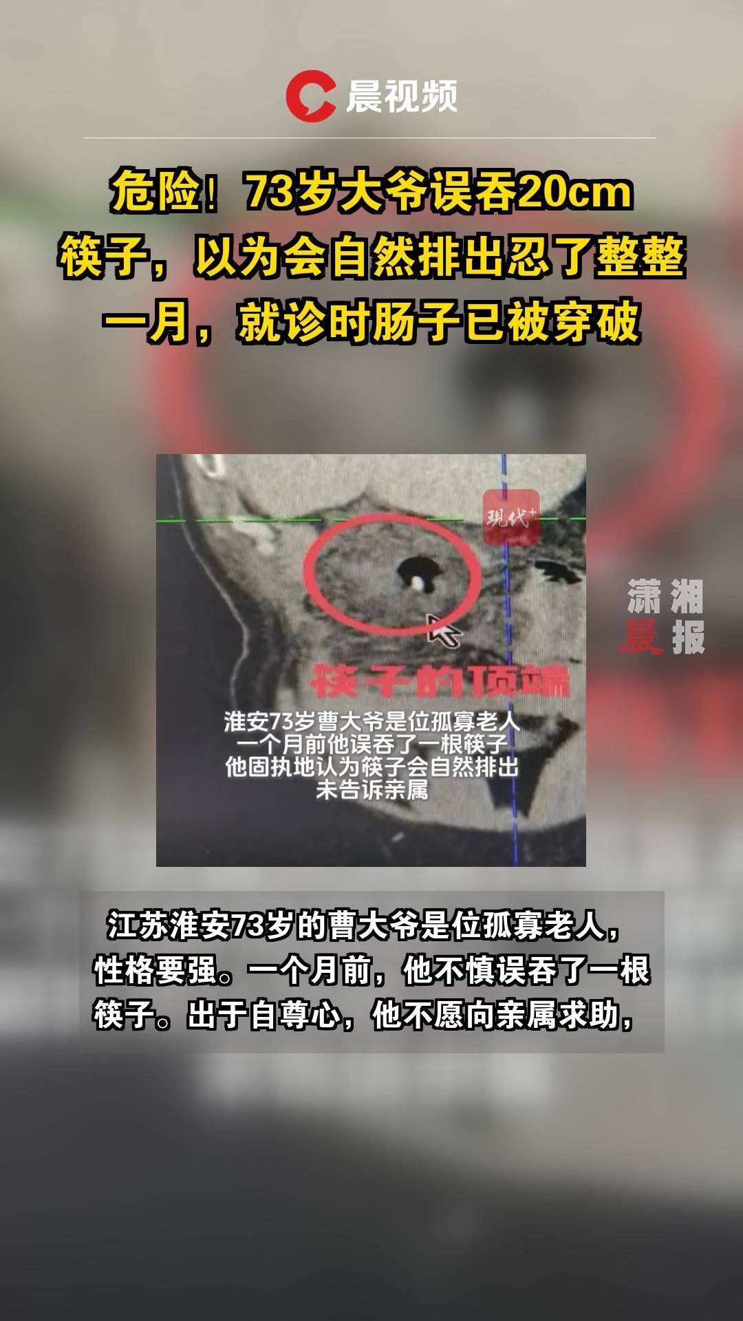 危险!73岁大爷误吞20cm筷子,以为会自然排出忍了整整一月,就诊时...