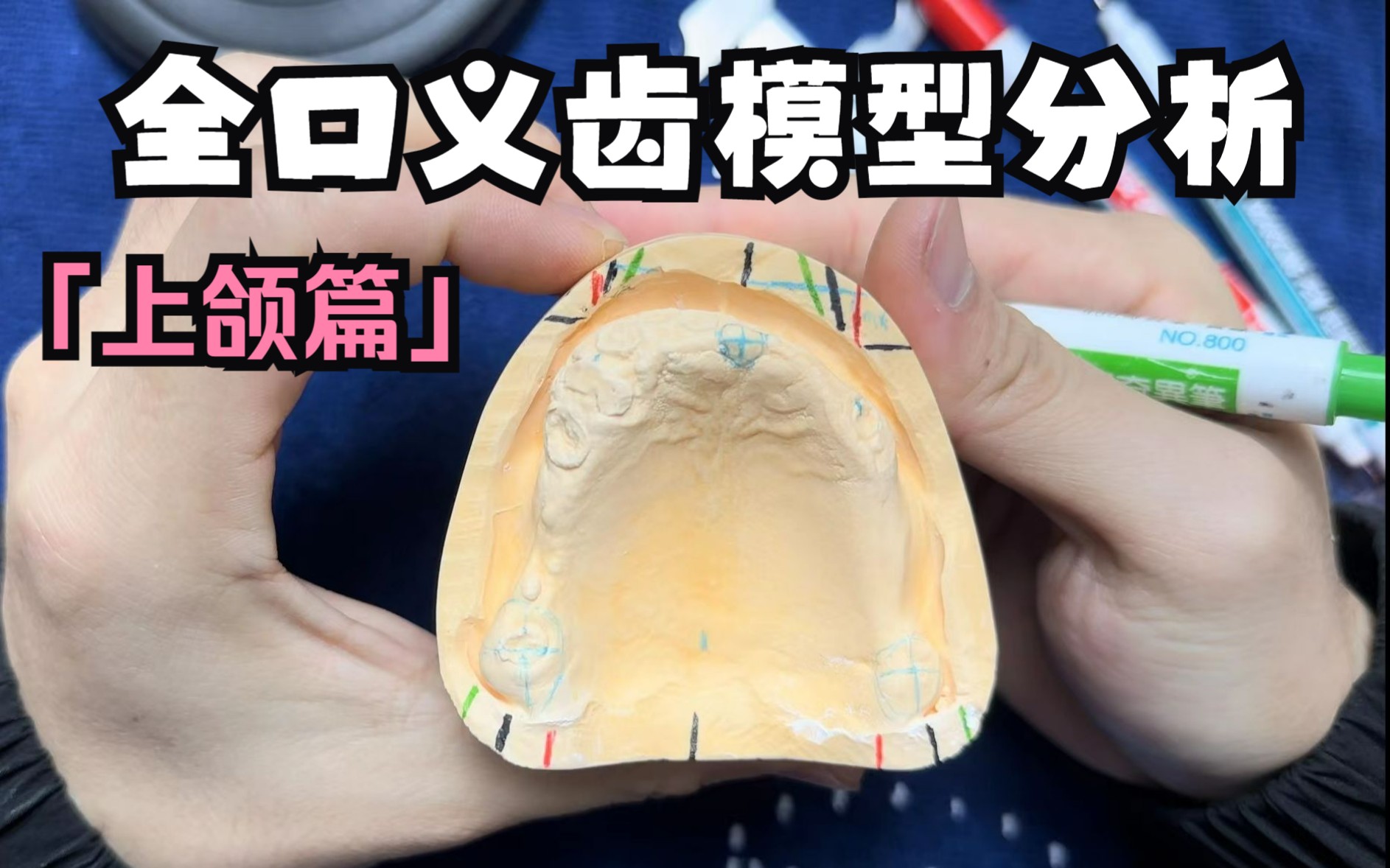 全口义齿干货课程-EP11-全口义齿的模型分析(上颌),找出最合适的排牙...