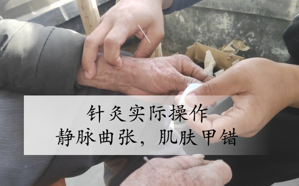 针灸穴位下针详细讲解——合谷、经渠、太白(视频内容有缺失,等下次...