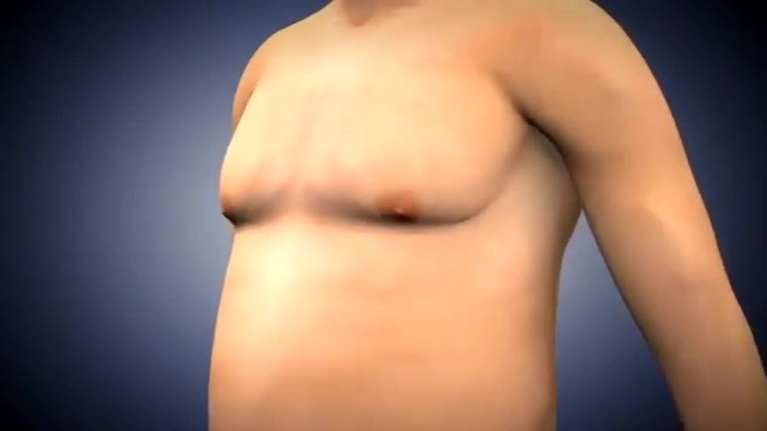 心脏主动脉瓣置换手术 动画视频