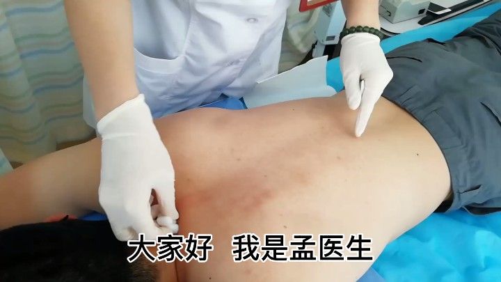 过敏性鼻炎除了用药物,还可以后背点刺放血加拔罐