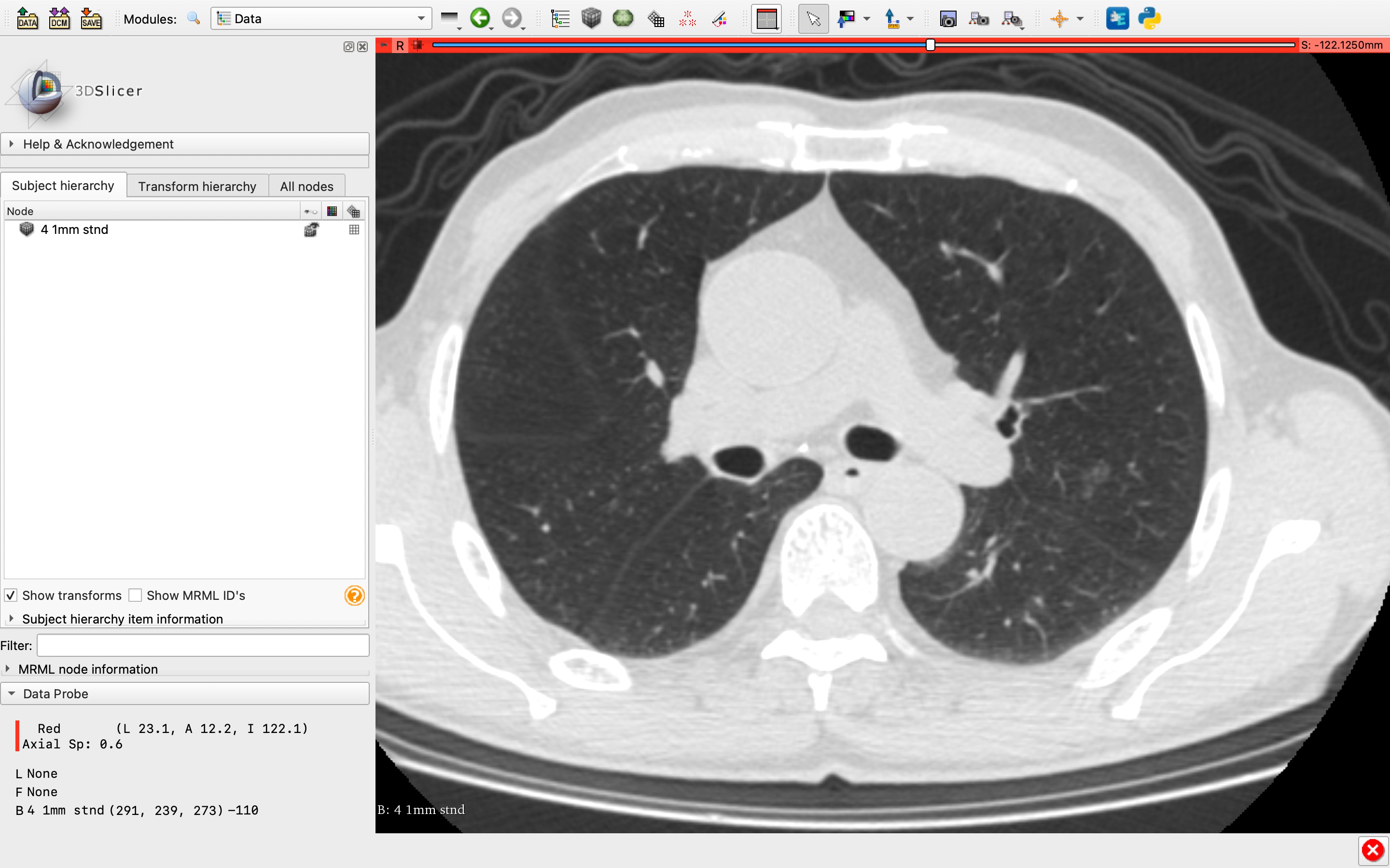 肺结节大小测量:是变大还是测量误差?