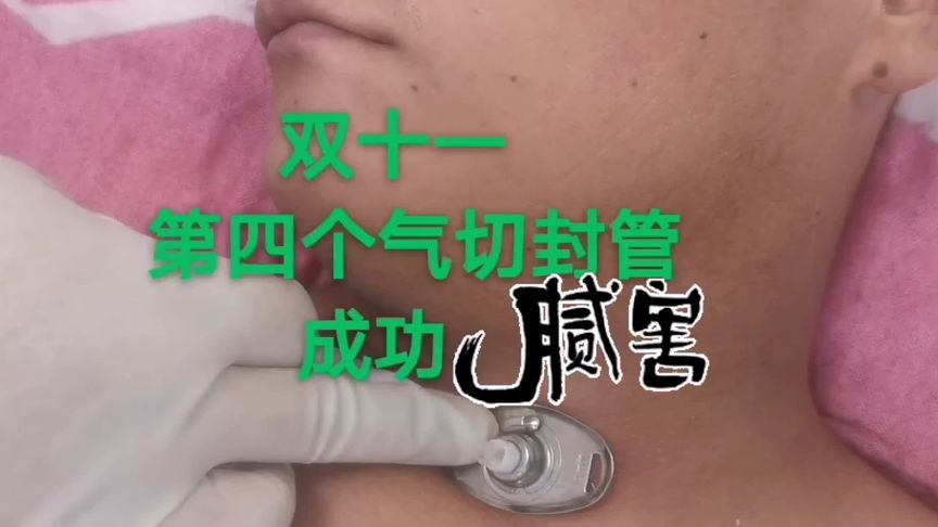 双十一第四个气切封管,成功。