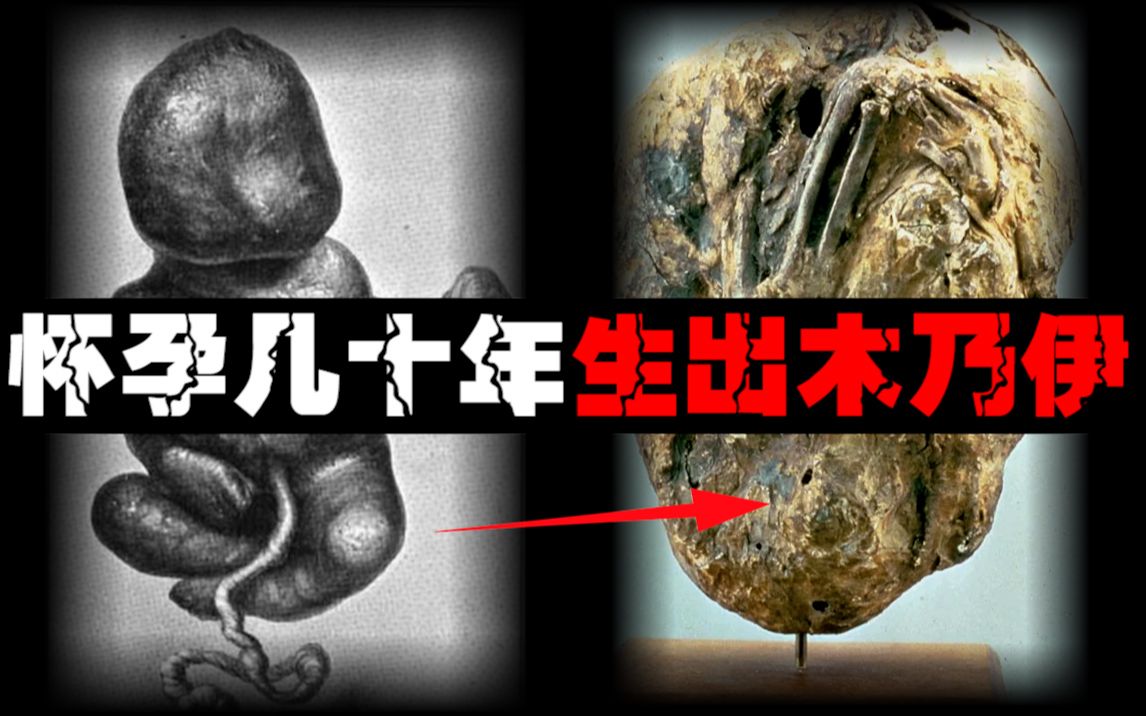 【石胎】为保护孕妈,死婴做出了这样的反应