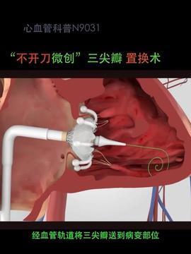 ...动画形式进行科普。#健康科普 #瓣膜病 #心脏病 #孟自力 #健康 @心...