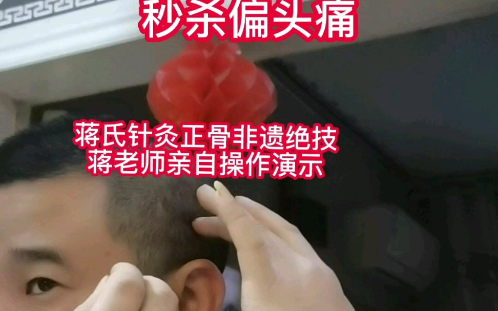 宜宾蒋兵老师亲自演示,针功夫,“太阳透率谷穴”,秒杀偏头痛