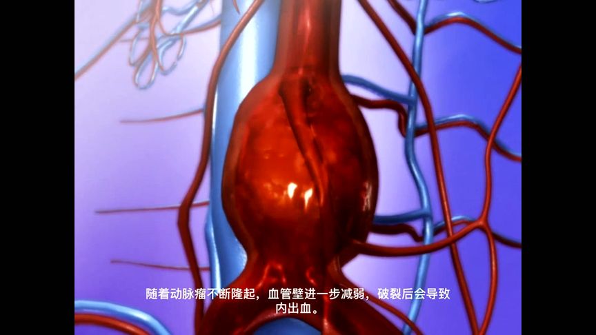 医学宣教——主动脉瘤