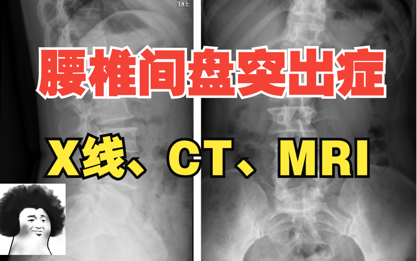 “一看就懂:腰椎间盘突出的X线、CT、MRI表现”
