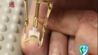 嵌甲矫正器及矫正丝的使用方法