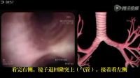 支气管镜检查(公益科普)