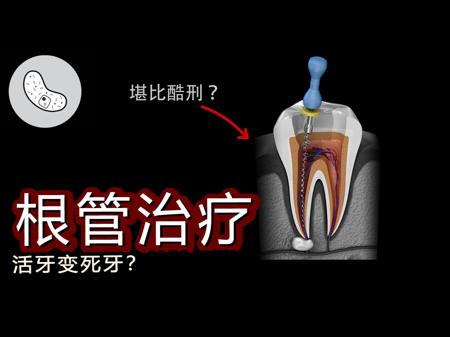 【根管治疗】活牙变死牙?抽神经是怎样一种体验?