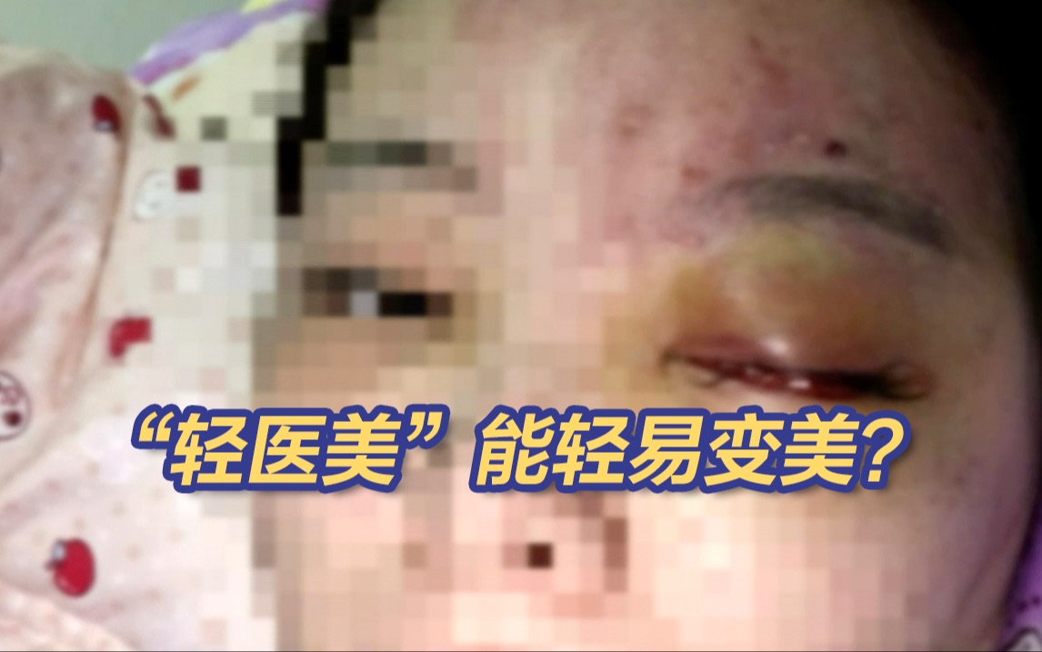 央视曝轻医美乱象:外用润滑剂竟注射面部