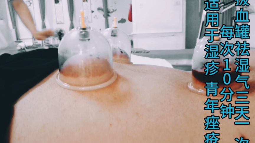 肝胆湿热 青年痤疮 湿疹拔血罐