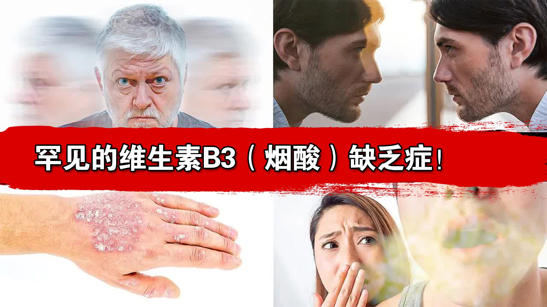 罕见的维生素B3(烟酸)缺乏症!
