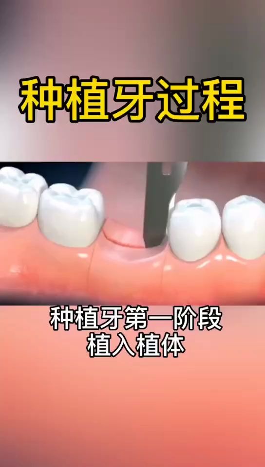 ...植牙「大连齿医生口腔种植中心」「大连口腔医院」「大连种牙价格...