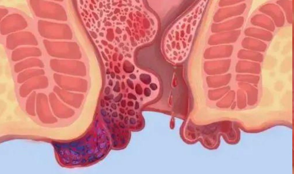 痔疮在家就能解决!方法选对才是重点!