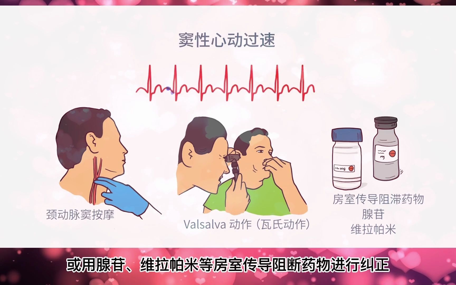 【心律失常】我的心跳好快,心悸、心慌原因之一(窦性心动过速)