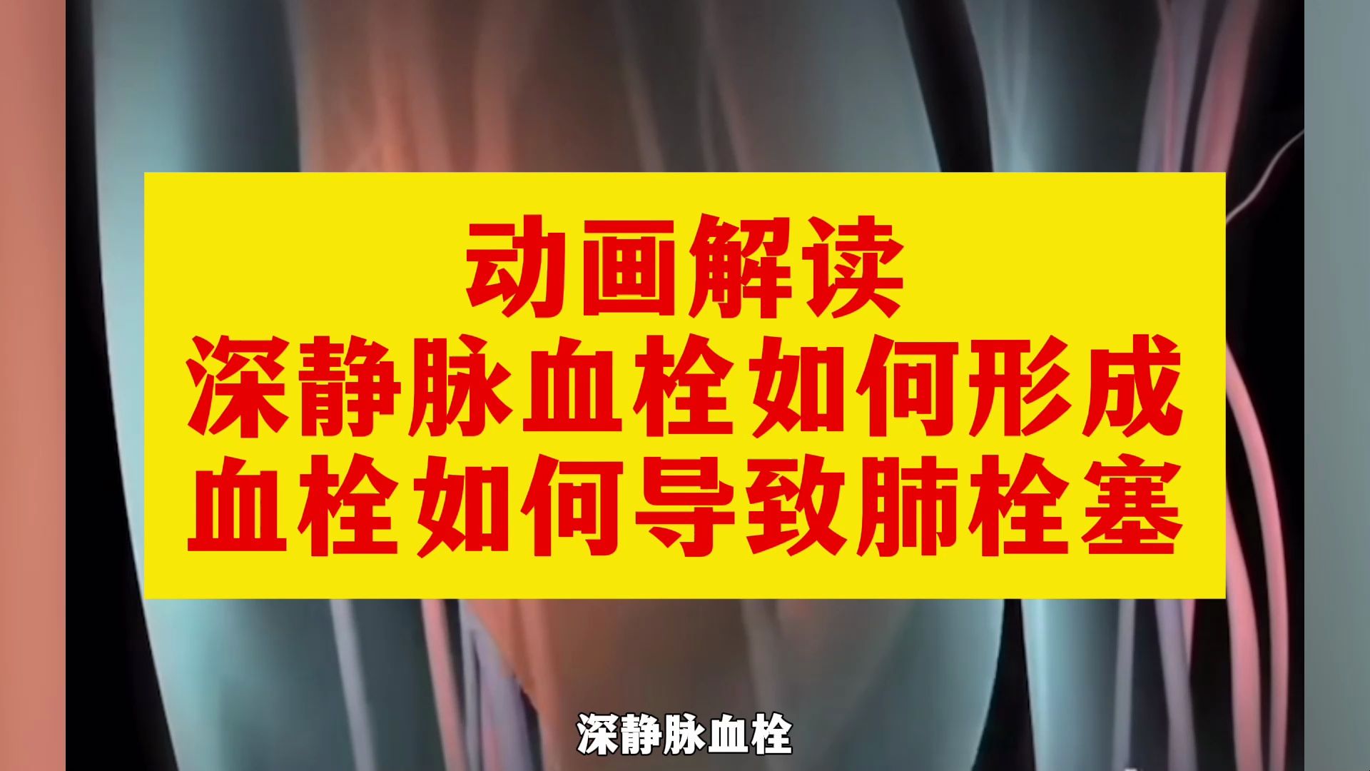 动画解读,深静脉血栓的形成,肺栓塞的形成。