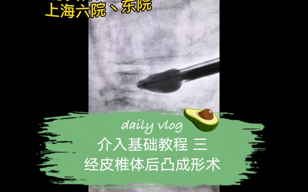 介入基础教程 三经皮椎体后凸成形术